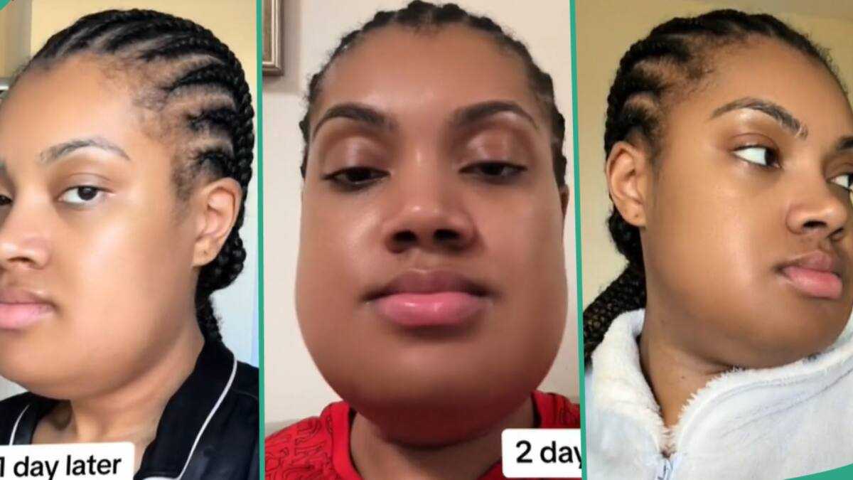 "You Look Amazing": Lady Goes Through Surgery to Reduce Her Jaw Size ...